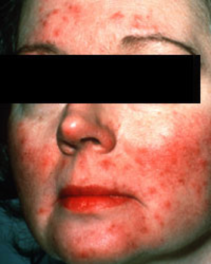 Rosacea Symptoms – Decode Your Rosacea Subtype | CosmedixUK