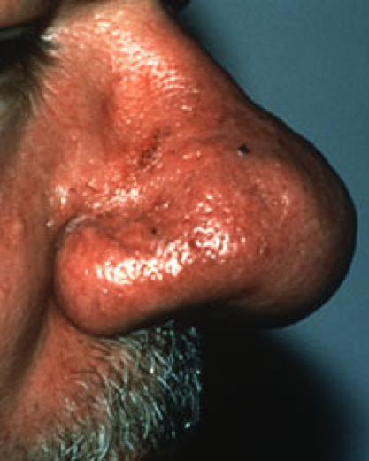 Rosacea Symptoms – Decode Your Rosacea Subtype | CosmedixUK